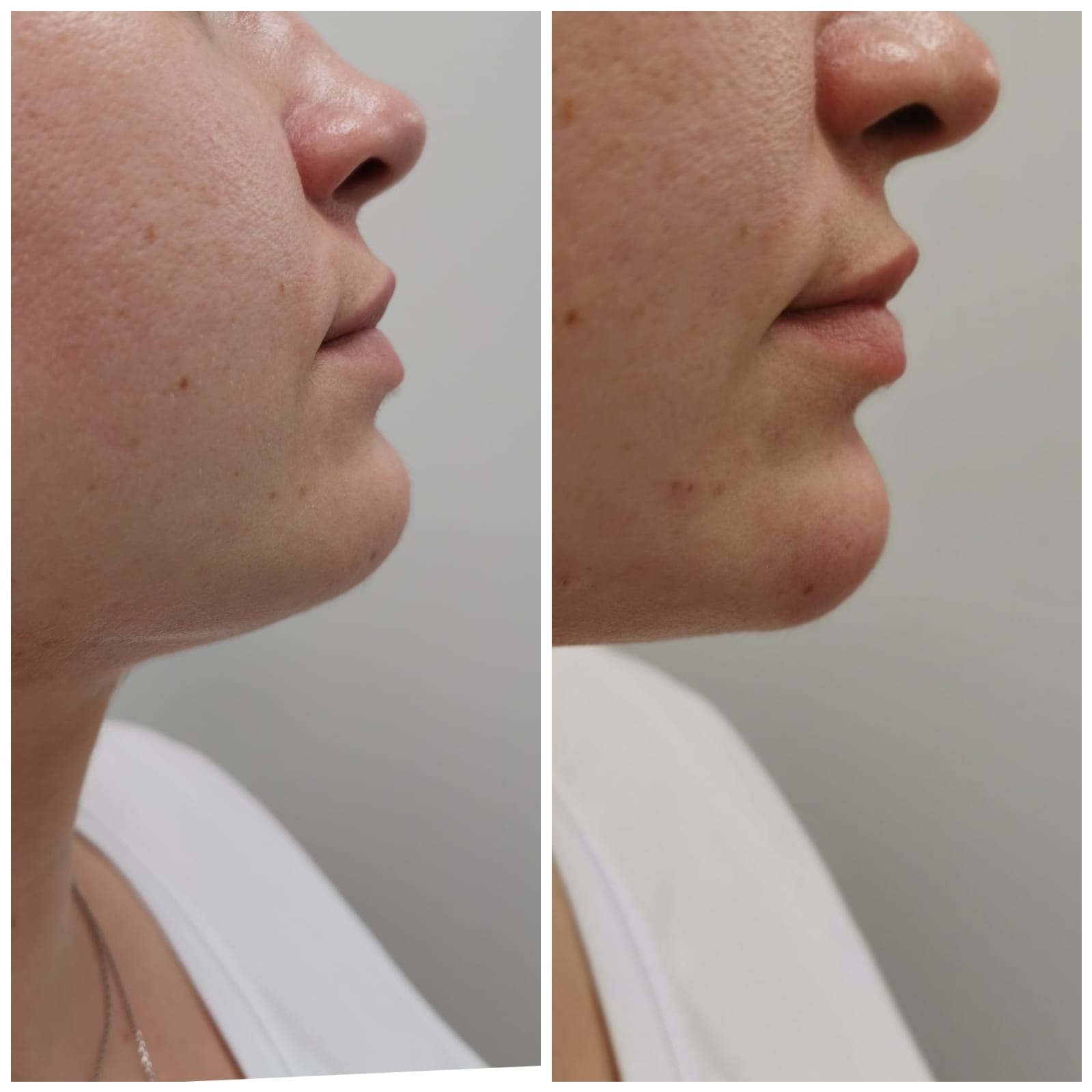 Klinka Dr Stachura powiększanie ust Szczecin. Kwas hialuronowy szczecin